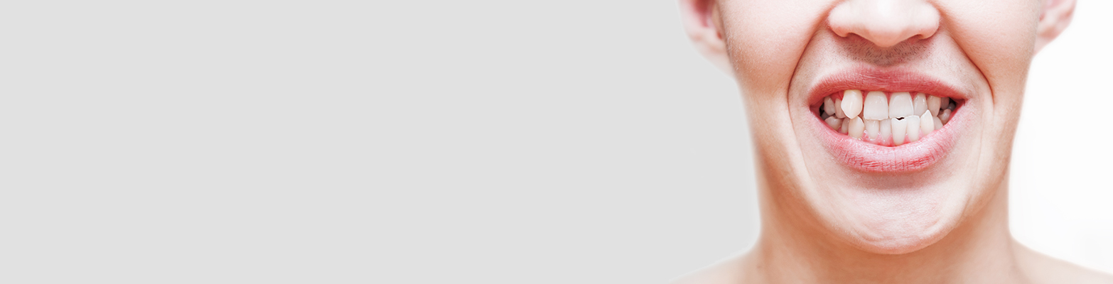 Crooked Teeth Treatment – Fix Crooked Tooth