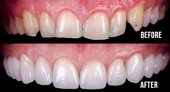 Composite Bonding London | Composite Bonding Prices