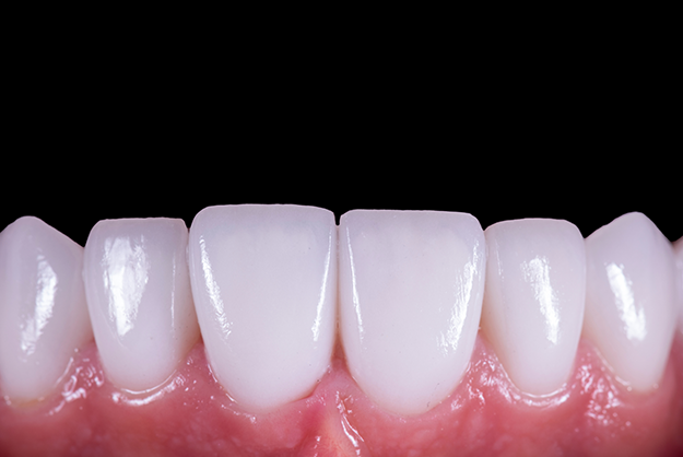 Emax Veneers Cost UK | Emax Porcelain Veneers Near Me