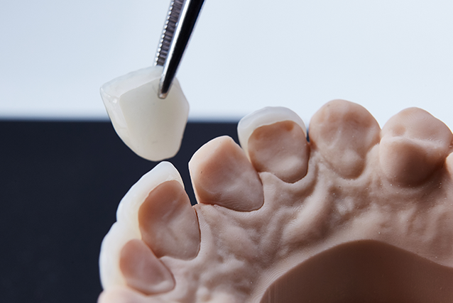 Emax Veneers Cost UK | Emax Porcelain Veneers Near Me