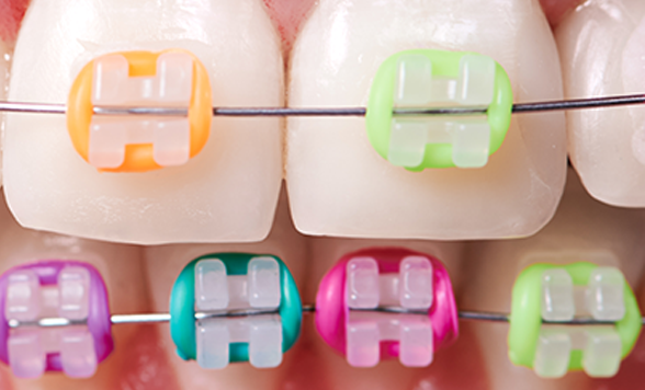 Fixed Retainer Braces Cost UK | Fixed Braces Price