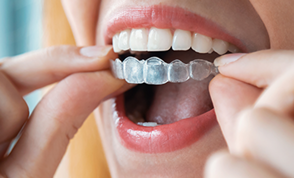 Invisalign Treatment Cost London, UK | Invisalign Price