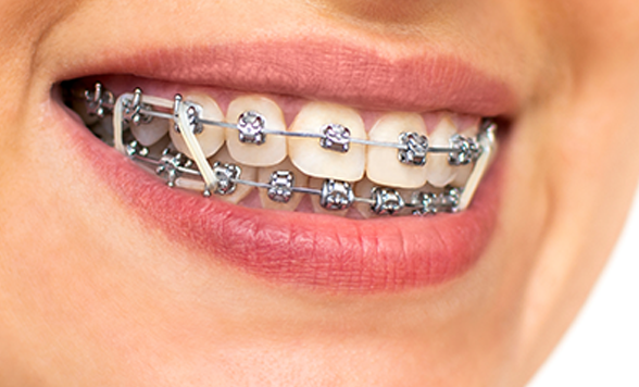 Fixed Retainer Braces Cost UK | Fixed Braces Price