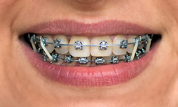 Fixed Retainer Braces Cost UK | Fixed Braces Price