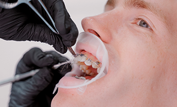 Fixed Retainer Braces Cost UK | Fixed Braces Price