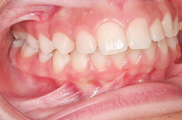 Deep Bite: Know About Causes, Symptoms & Treatment Options